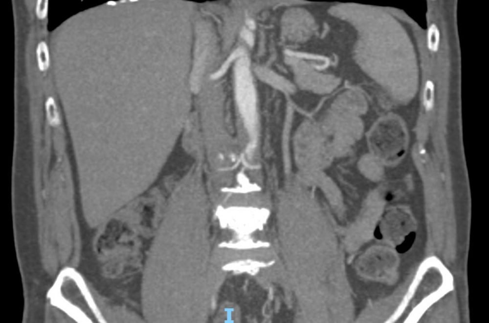 Lower Limb Salvage, successful Aorta bifemoral bypass via left ...